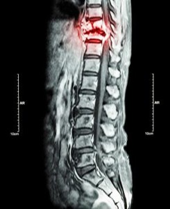 Degenerative Spondylolisthesis Treatment | The Spine Center