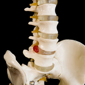 Total Disc Arthroplasty Treatments | Chicagoland | The Spine Center